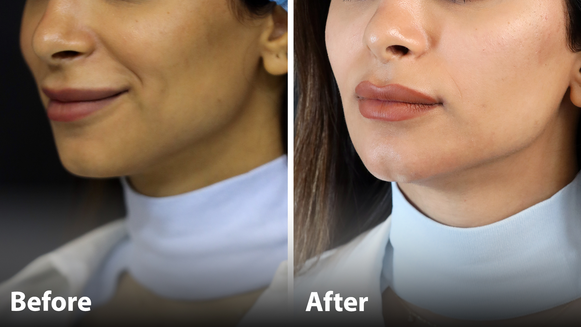 Before & After - Proderma