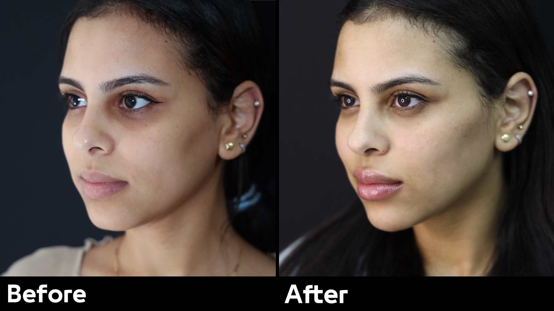 Before & After - Proderma
